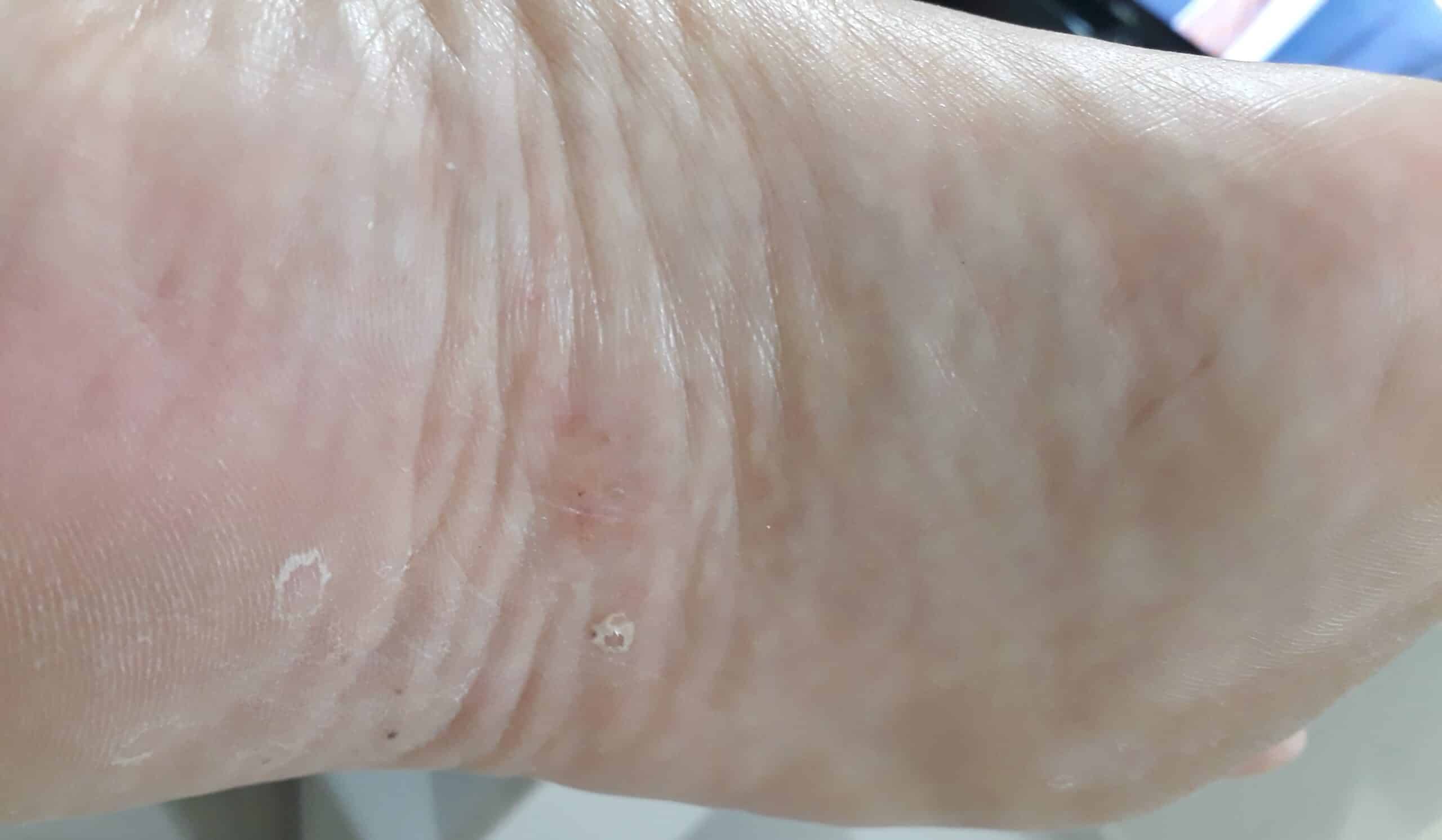 Disidrose - Eczema disidrótico - Saiba mais - Envelheci e Agora?