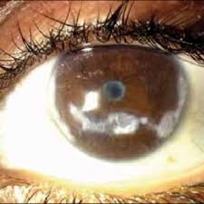 Esclerite - Causas, sintomas e tratamento - Envelheci e Agora?